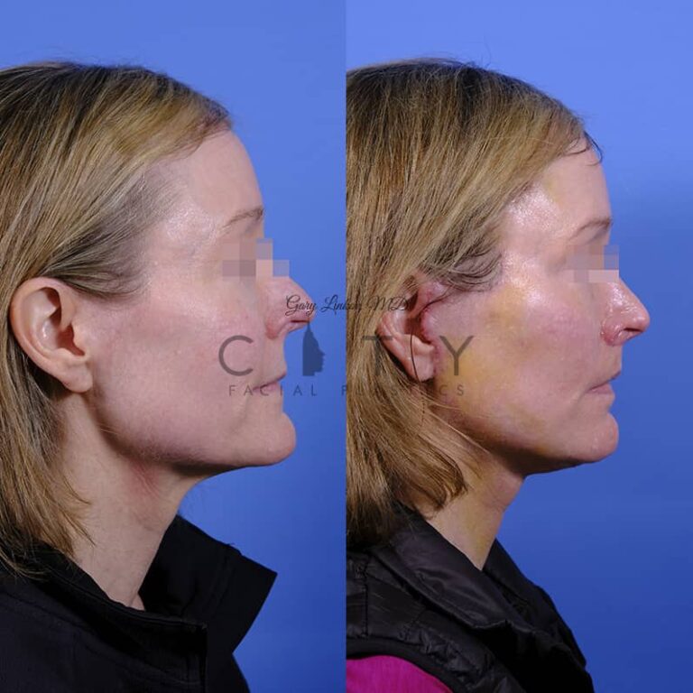 NYC Face & Neck Cosmetic Plastic Surgery Procedures | New York