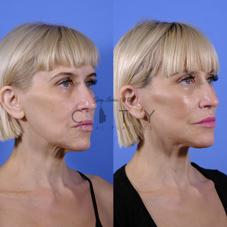 Facelift in NYC | Best Facelift Surgery New York City