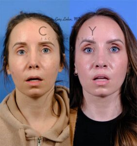 NYC Bullhorn Lip Lift Surgery | New York Subnasal Lip Enhancement