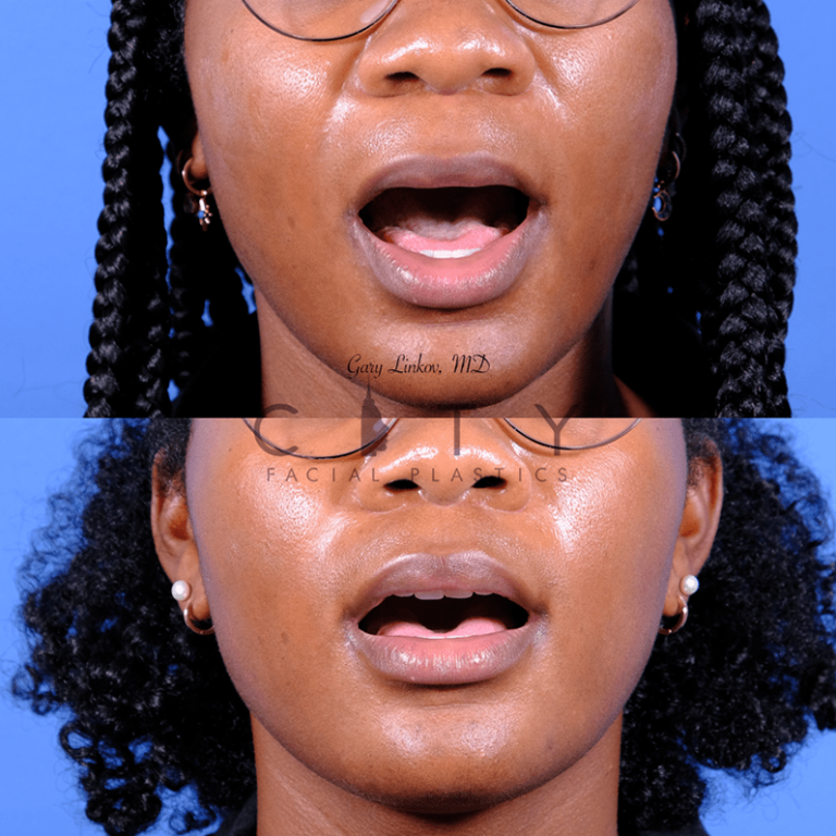 Lip Lift in New York City | Upper Lip Lift Surgery Manhattan