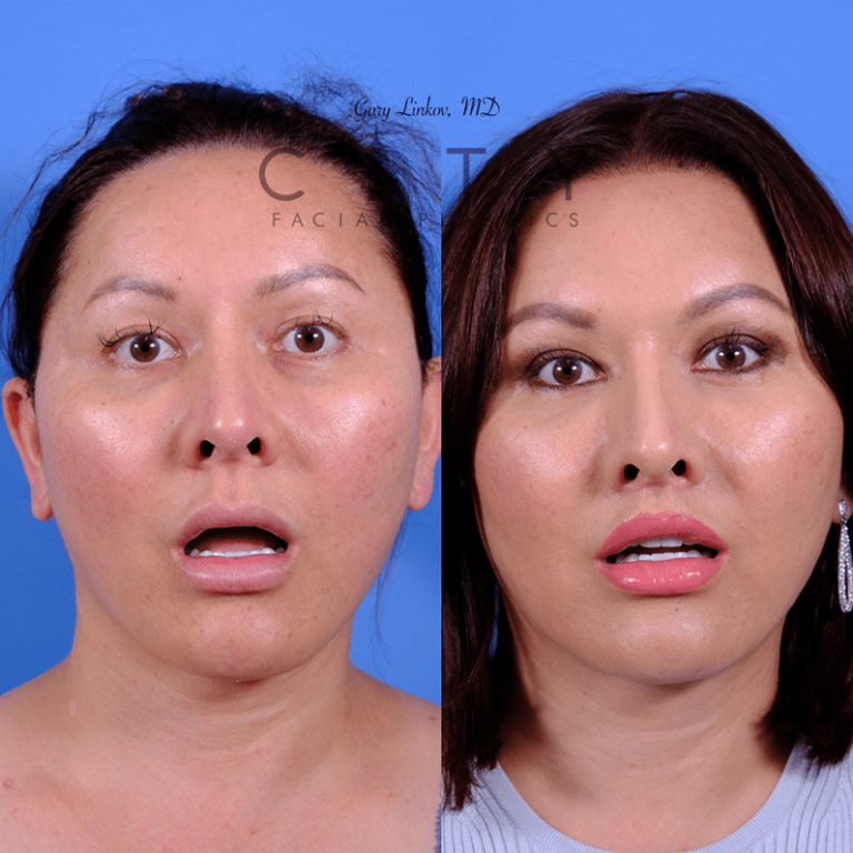 NYC Bullhorn Lip Lift Surgery | New York Subnasal Lip Enhancement