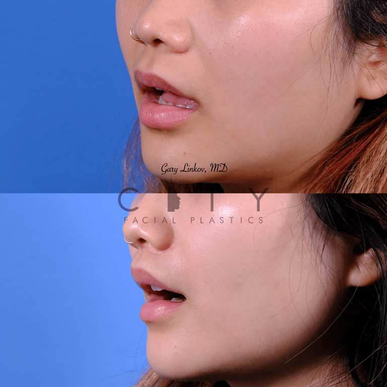 NYC Bullhorn Lip Lift Surgery | New York Subnasal Lip Enhancement