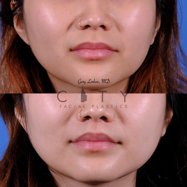 Lip Lift in New York City | Upper Lip Lift Surgery Manhattan