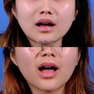NYC Bullhorn Lip Lift Surgery | New York Subnasal Lip Enhancement