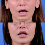 Lip Enhancement NYC | Lip Augmentation New York City