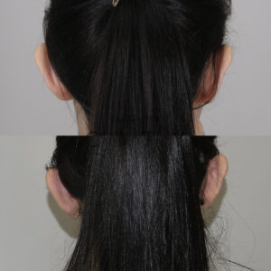 Otoplasty in NYC | Ear Surgery Manhattan