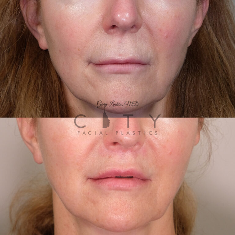 NYC Bullhorn Lip Lift Surgery | New York Subnasal Lip Enhancement