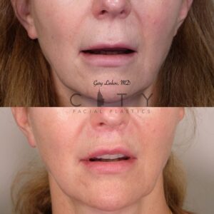 NYC Bullhorn Lip Lift Surgery | New York Subnasal Lip Enhancement