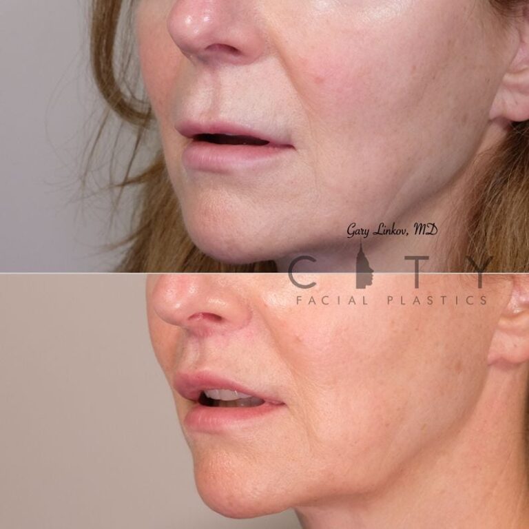 NYC Bullhorn Lip Lift Surgery | New York Subnasal Lip Enhancement