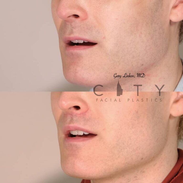 NYC Bullhorn Lip Lift Surgery | New York Subnasal Lip Enhancement