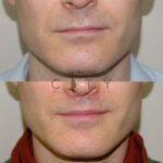 NYC Bullhorn Lip Lift Surgery | New York Subnasal Lip Enhancement