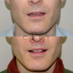 NYC Bullhorn Lip Lift Surgery | New York Subnasal Lip Enhancement