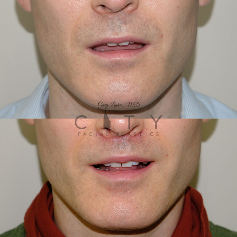 Lip Lift in New York City | Upper Lip Lift Surgery Manhattan