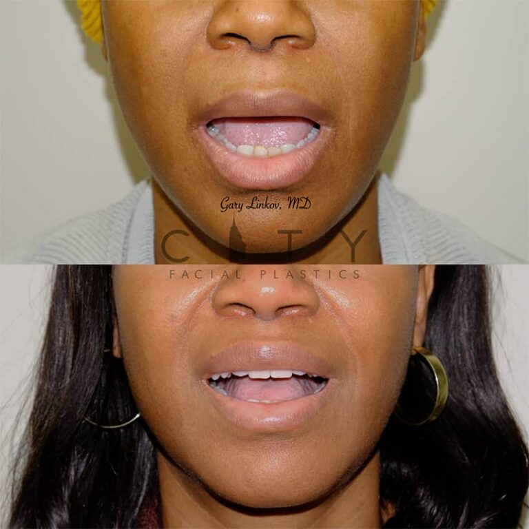 NYC Bullhorn Lip Lift Surgery | New York Subnasal Lip Enhancement