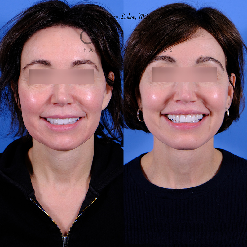 NYC Facelift Surgery Before and After Pictures | New York