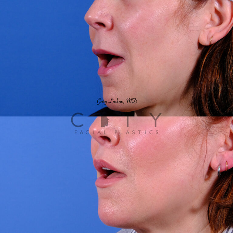 Lip Lift in New York City | Upper Lip Lift Surgery Manhattan