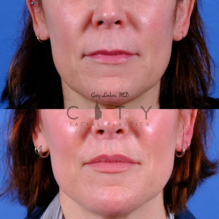 Lip Lift in New York City | Upper Lip Lift Surgery Manhattan