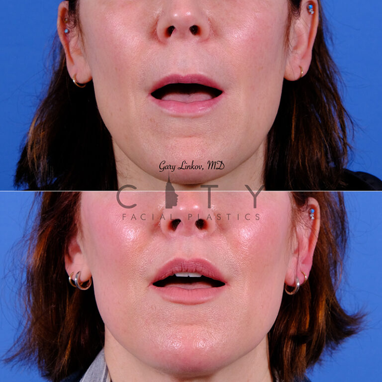 Lip Lift in New York City | Upper Lip Lift Surgery Manhattan