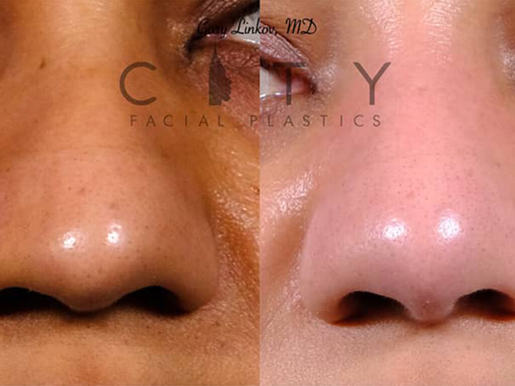 NYC Nostril Reduction Before and After Pictures | New York | UES