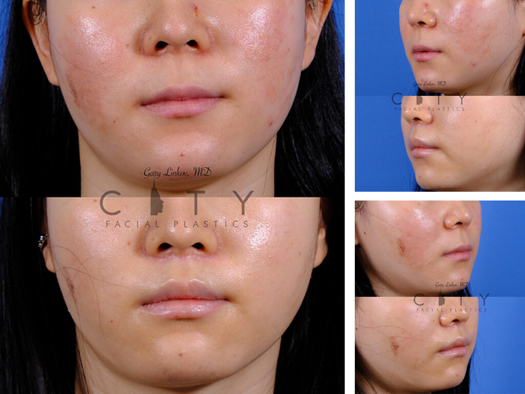 Lip Lift Before and After | New York Plastic Surgeon Dr. Linkov