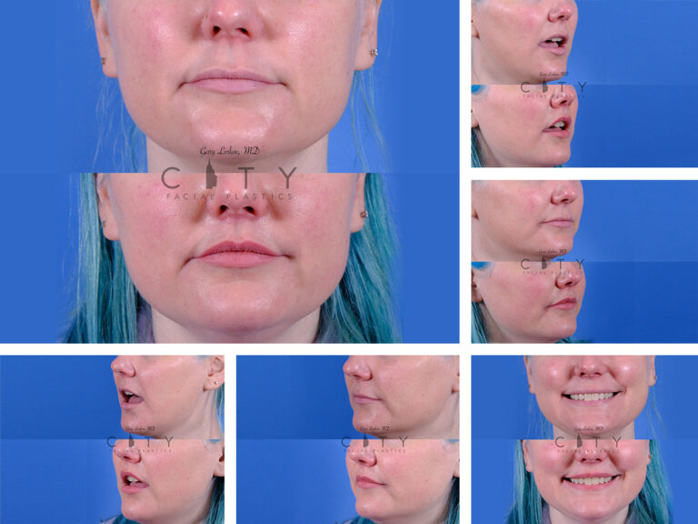 Lip Lift Before and After | New York Plastic Surgeon Dr. Linkov