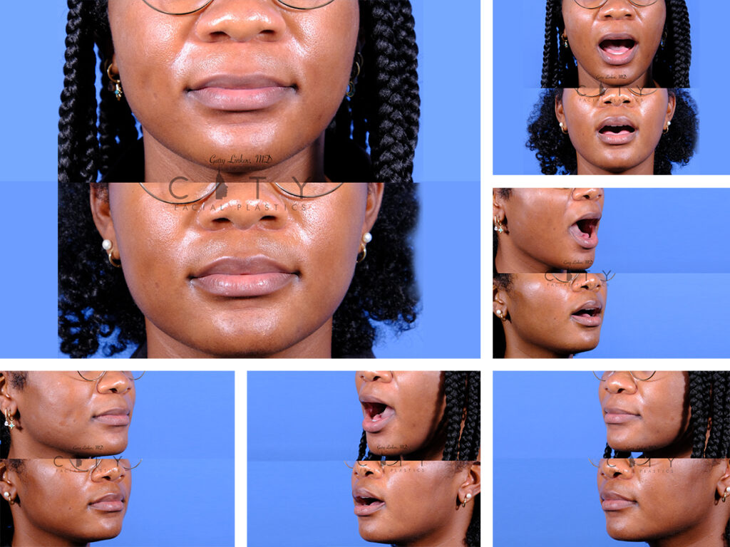 Lip Lift Before and After | New York Plastic Surgeon Dr. Linkov