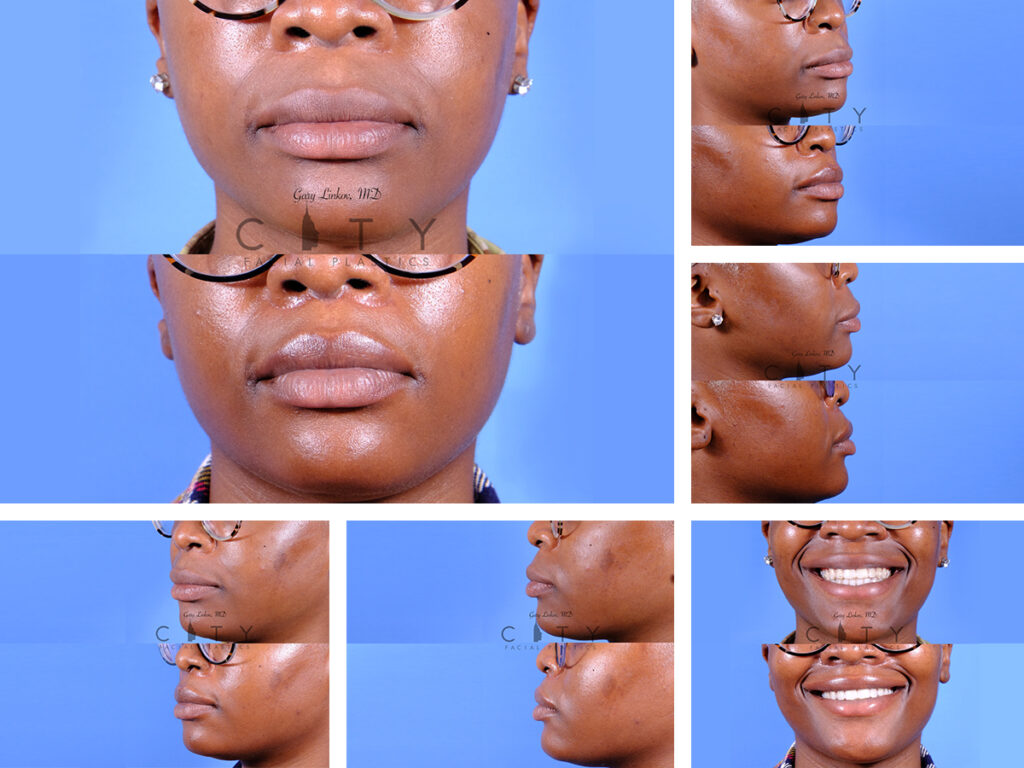 Lip Lift Before and After | New York Plastic Surgeon Dr. Linkov