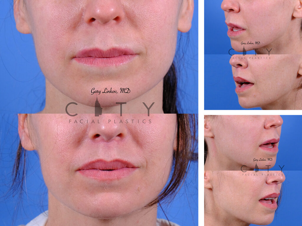 Lip Lift Before and After | New York Plastic Surgeon Dr. Linkov
