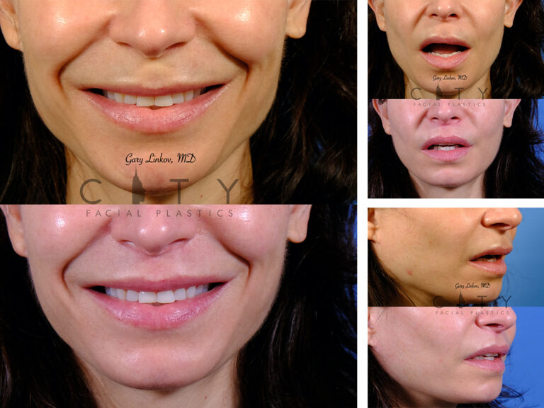Lip Lift Before and After | New York Plastic Surgeon Dr. Linkov
