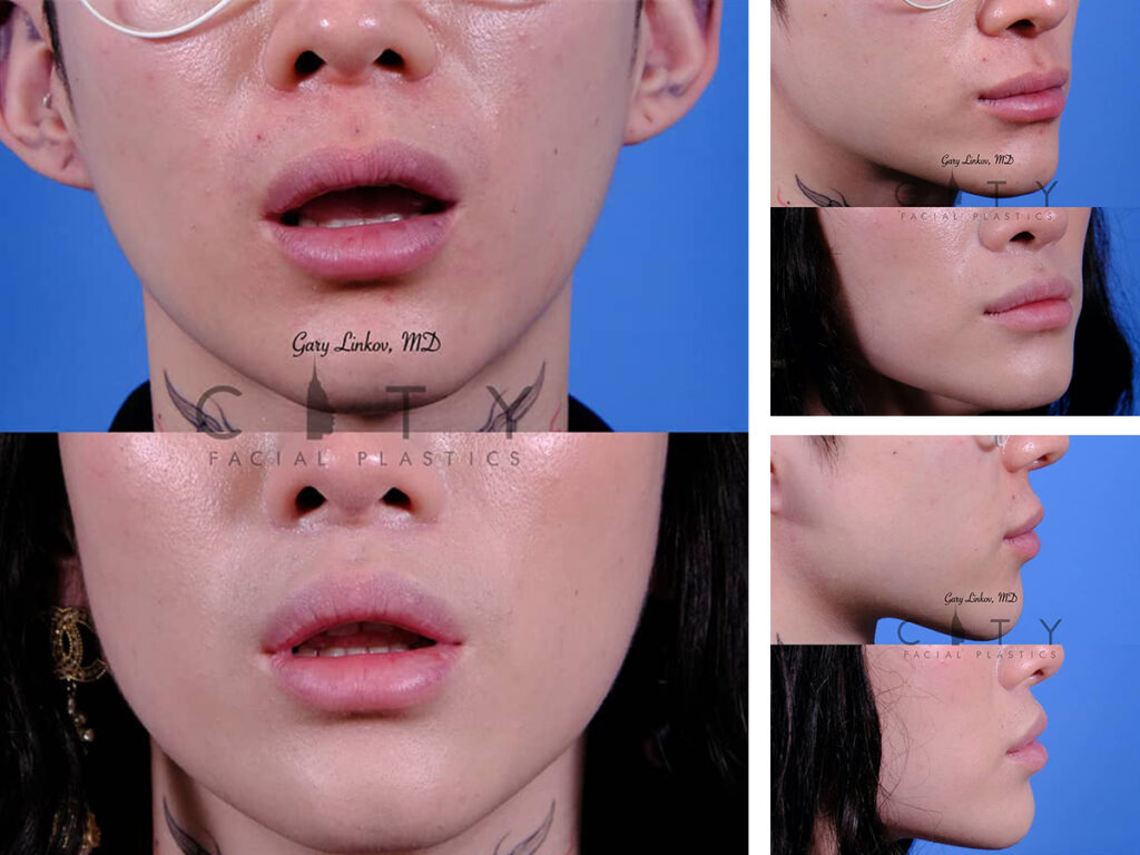 Lip Lift Before and After | New York Plastic Surgeon Dr. Linkov