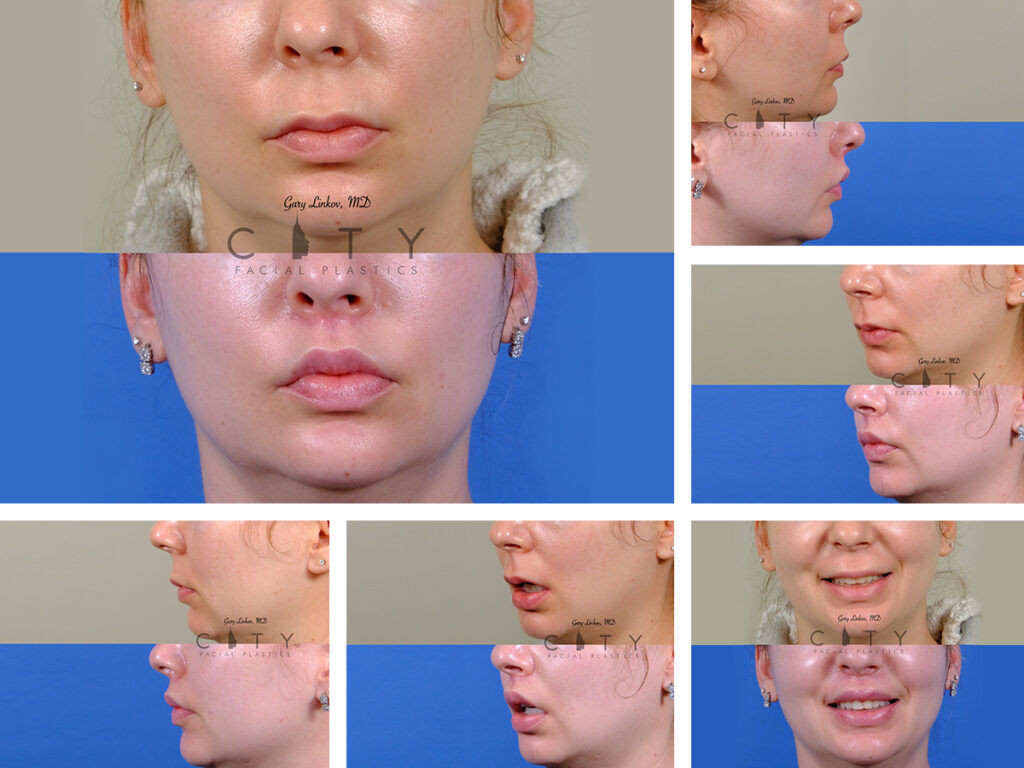 Lip Lift Before and After | New York Plastic Surgeon Dr. Linkov