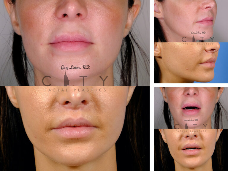 Lip Lift Before and After | New York Plastic Surgeon Dr. Linkov