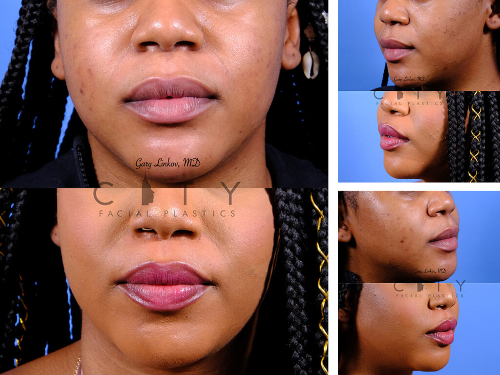 Lip Lift Before and After | New York Plastic Surgeon Dr. Linkov