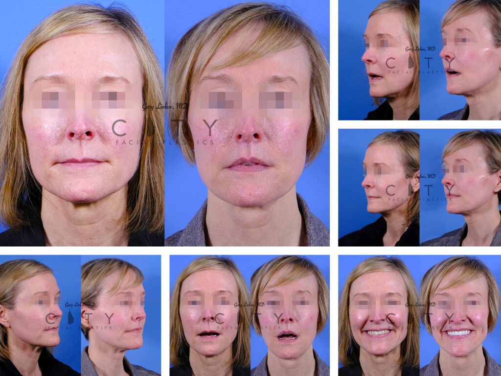 Lip Lift Before and After | New York Plastic Surgeon Dr. Linkov