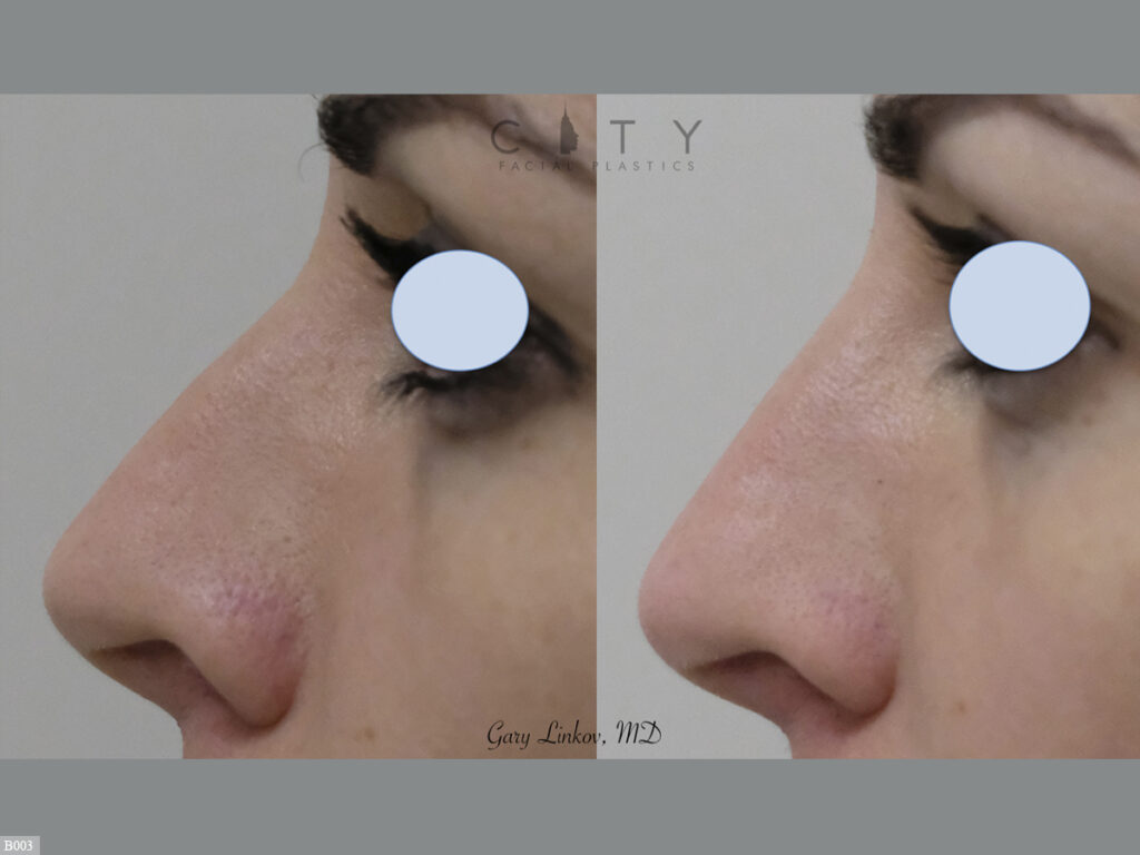 Botox and Filler Before and After | New York