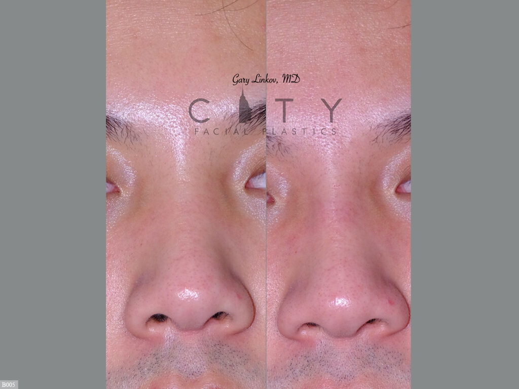 Botox and Filler Before and After | New York