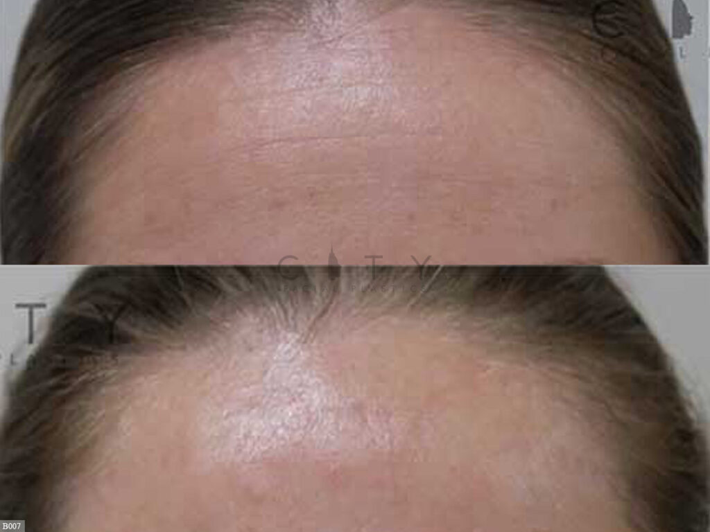 Botox and Filler Before and After | New York