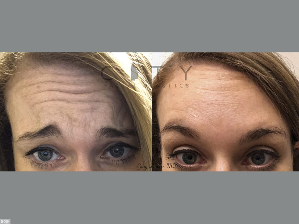 Botox and Filler Before and After | New York