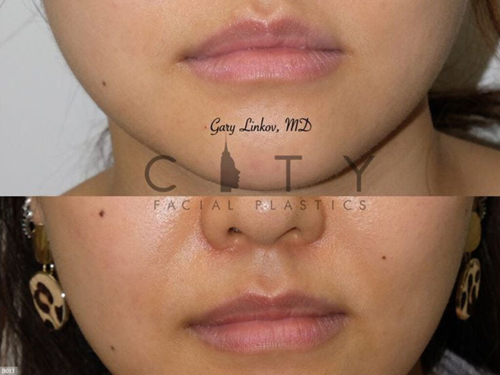 Botox and Filler Before and After | New York