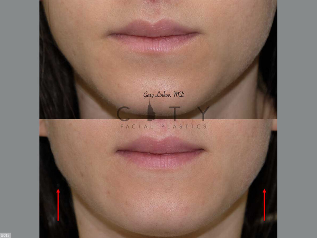 Botox and Filler Before and After | New York