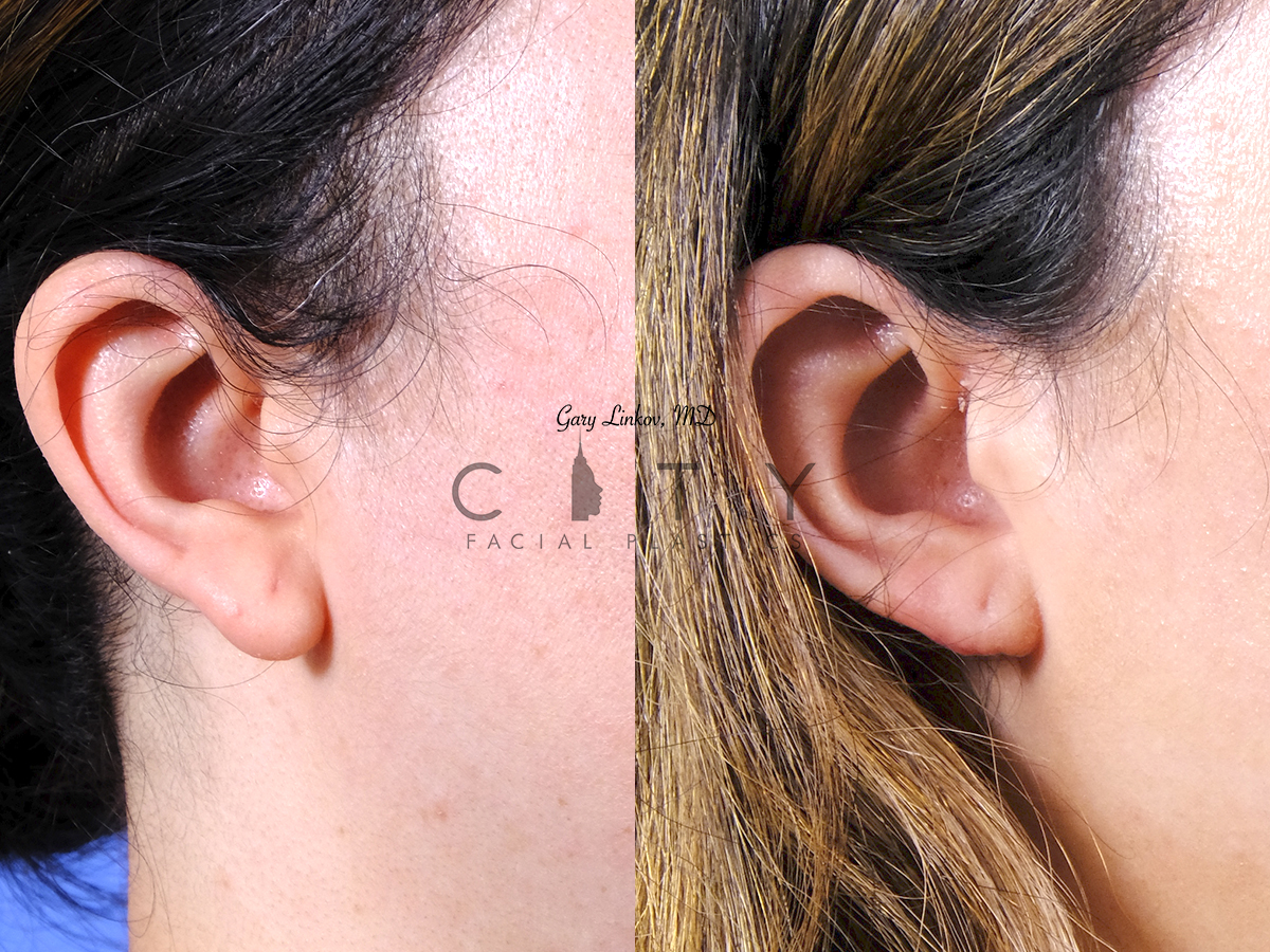 NYC Ear Lobe Repair Before and After Pictures | New York | UES