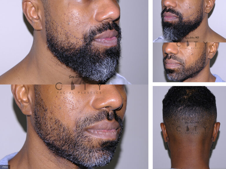 Nyc Hair Transplant Photo Gallery Before And After Pictures New York
