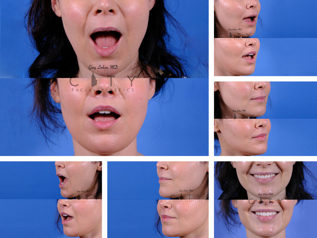 Lip Lift Before and After | New York Plastic Surgeon Dr. Linkov