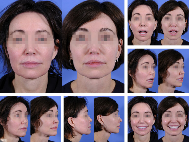 Lip Lift Before and After | New York Plastic Surgeon Dr. Linkov