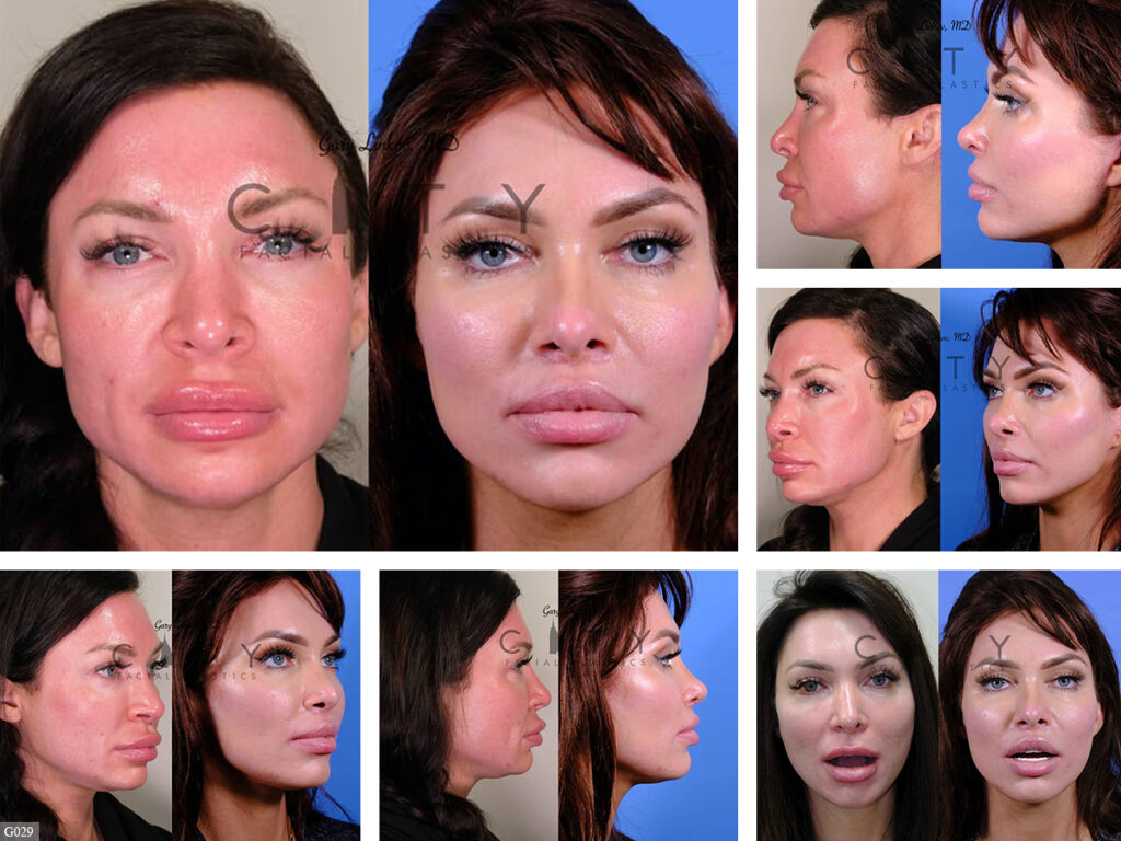 Lip Lift Before and After | New York Plastic Surgeon Dr. Linkov