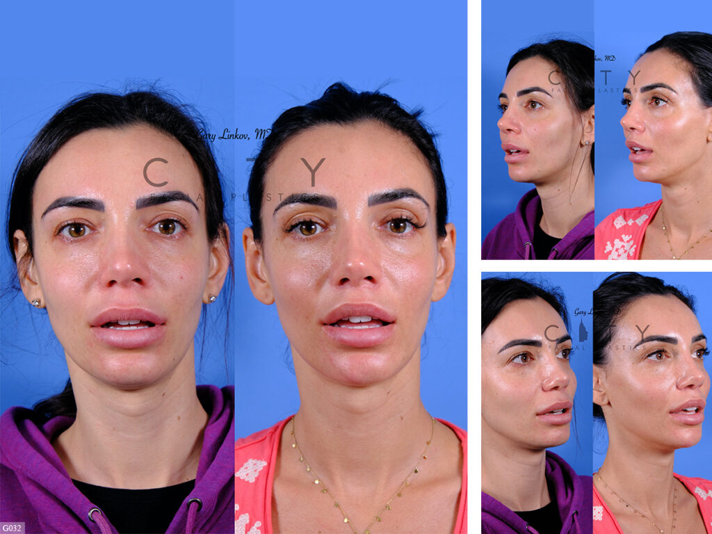 Lip Lift Before and After | New York Plastic Surgeon Dr. Linkov