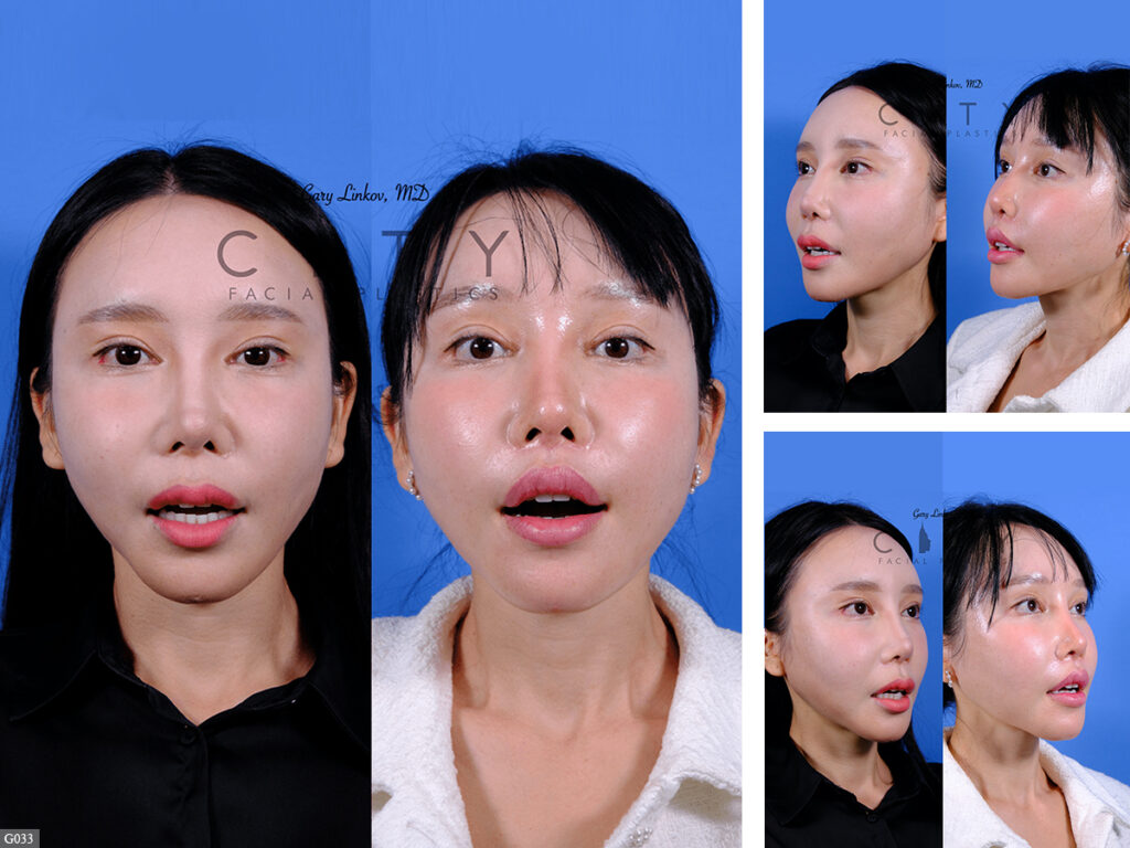 Lip Lift Before and After | New York Plastic Surgeon Dr. Linkov