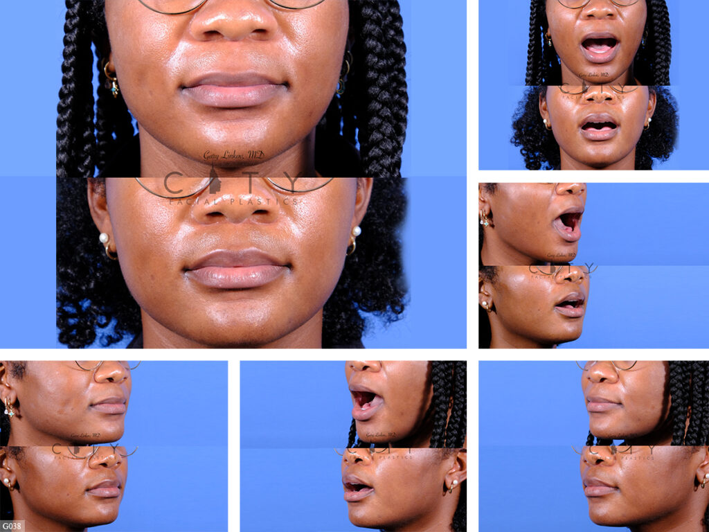 Lip Lift Before and After | New York Plastic Surgeon Dr. Linkov