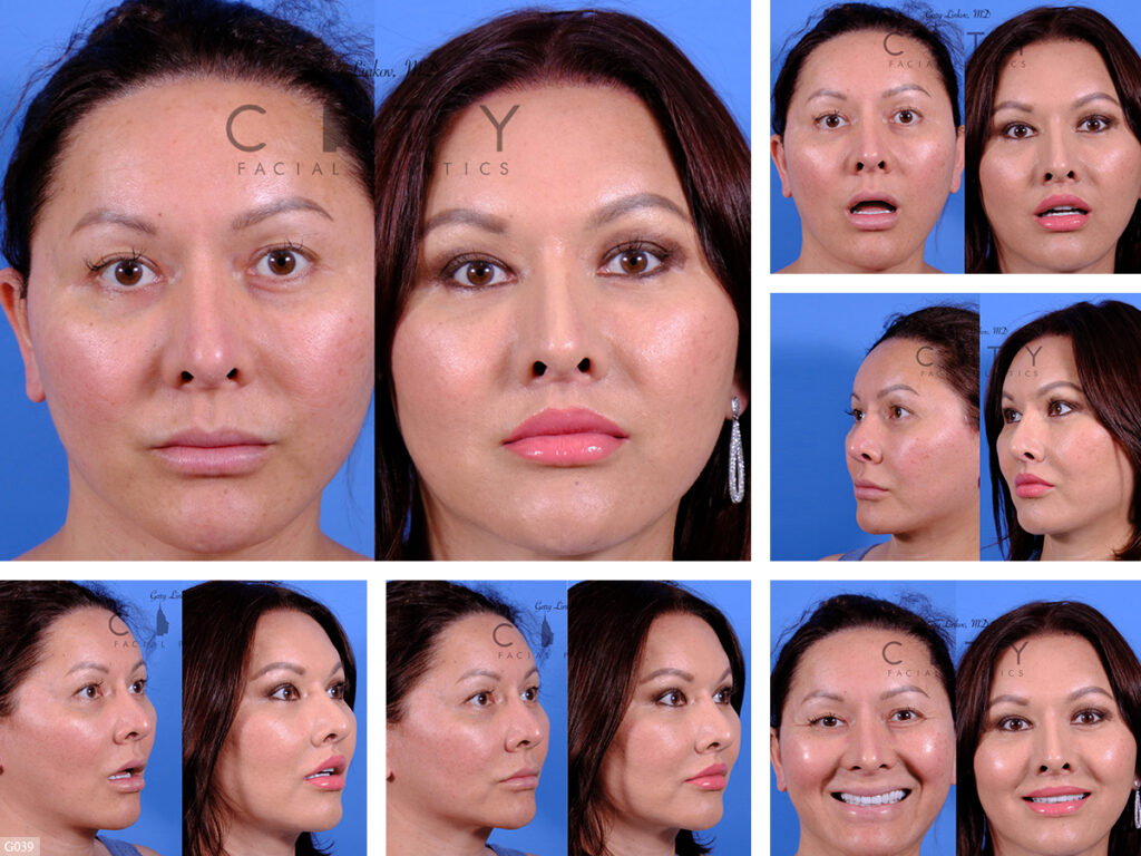 Lip Lift Before and After | New York Plastic Surgeon Dr. Linkov