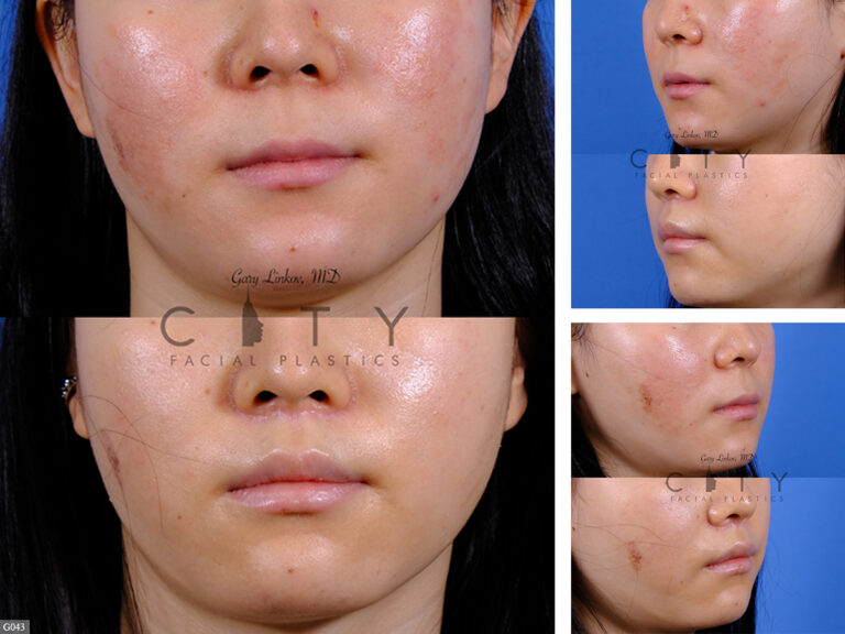 Lip Lift Before and After | New York Plastic Surgeon Dr. Linkov